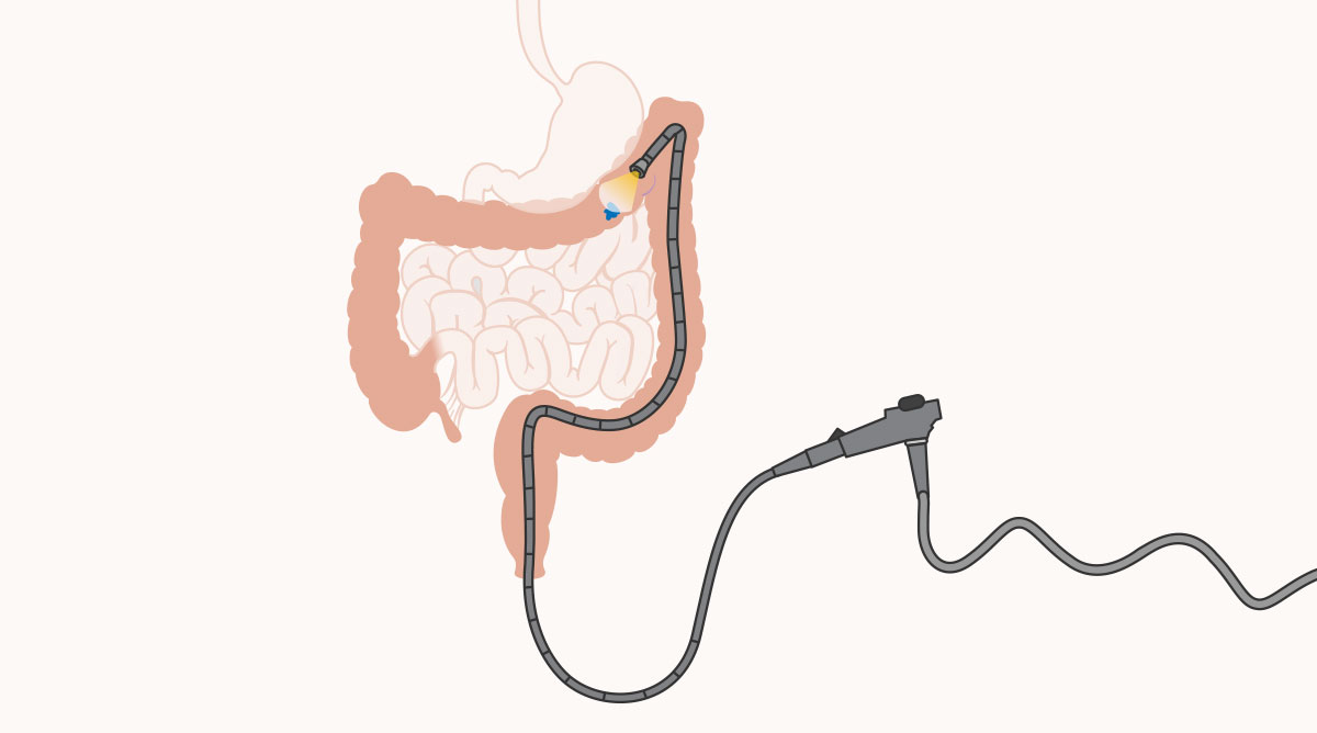 Kolonoskopia – Profilaktyka